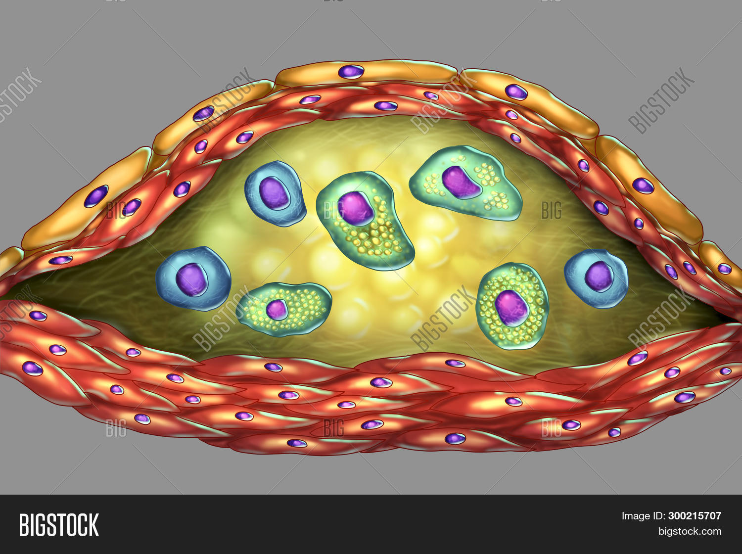 Structure Of Atherosclerotic Plaque. Illustration Showing Necrotic ...