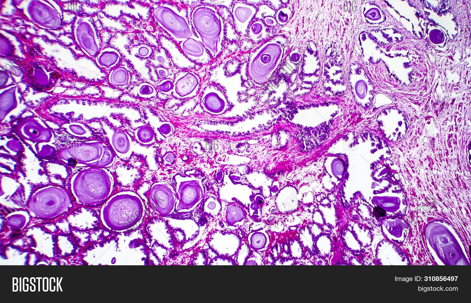 Histopathology Of Prostate Gland Hyperplasia, Light Micrograph, Photo ...