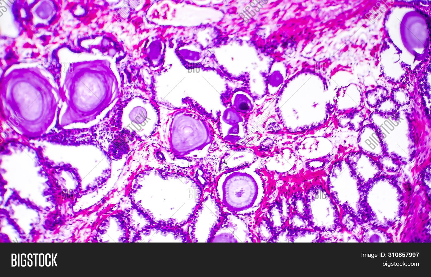Histopathology Of Prostate Gland Hyperplasia, Light Micrograph, Photo ...