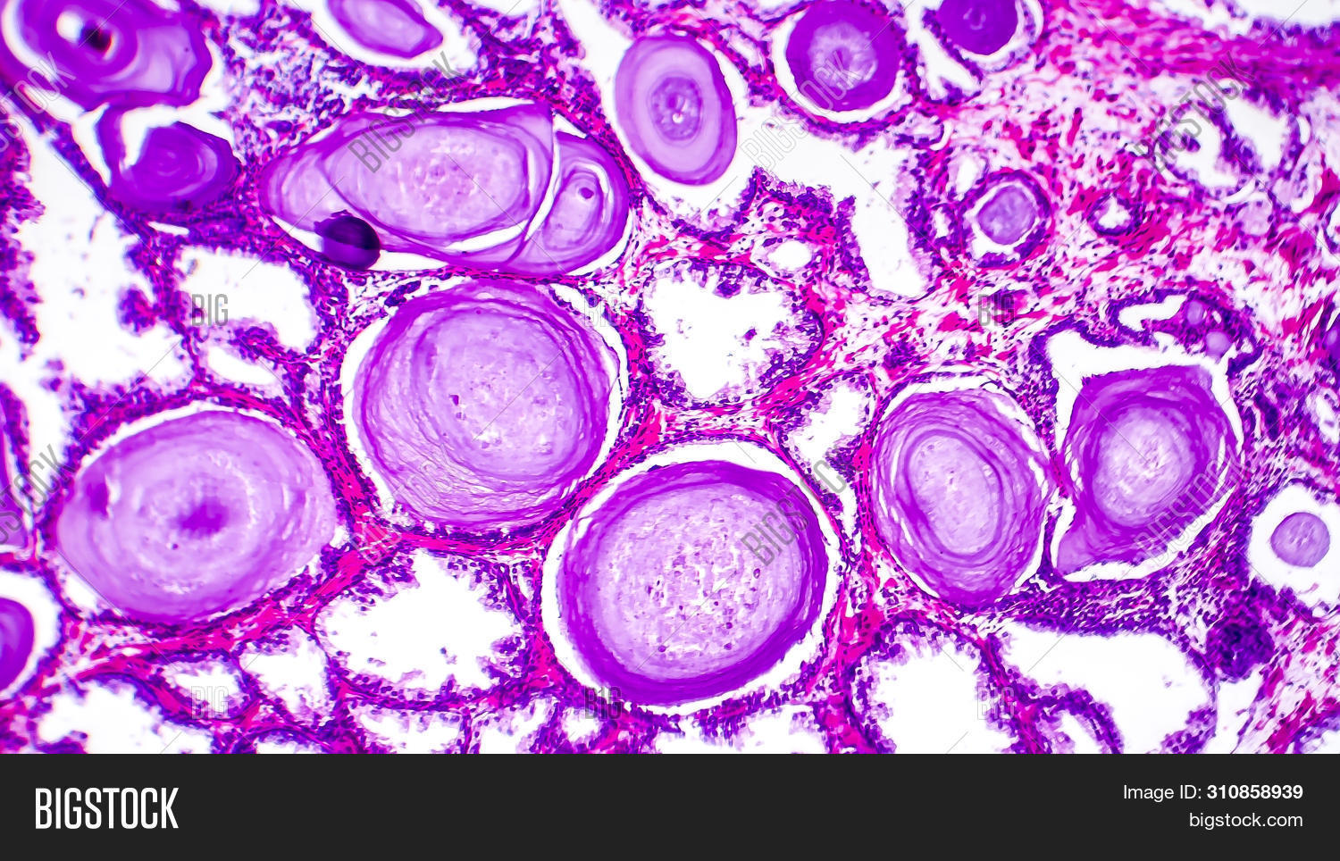 Histopathology Of Prostate Gland Hyperplasia, Light Micrograph, Photo ...