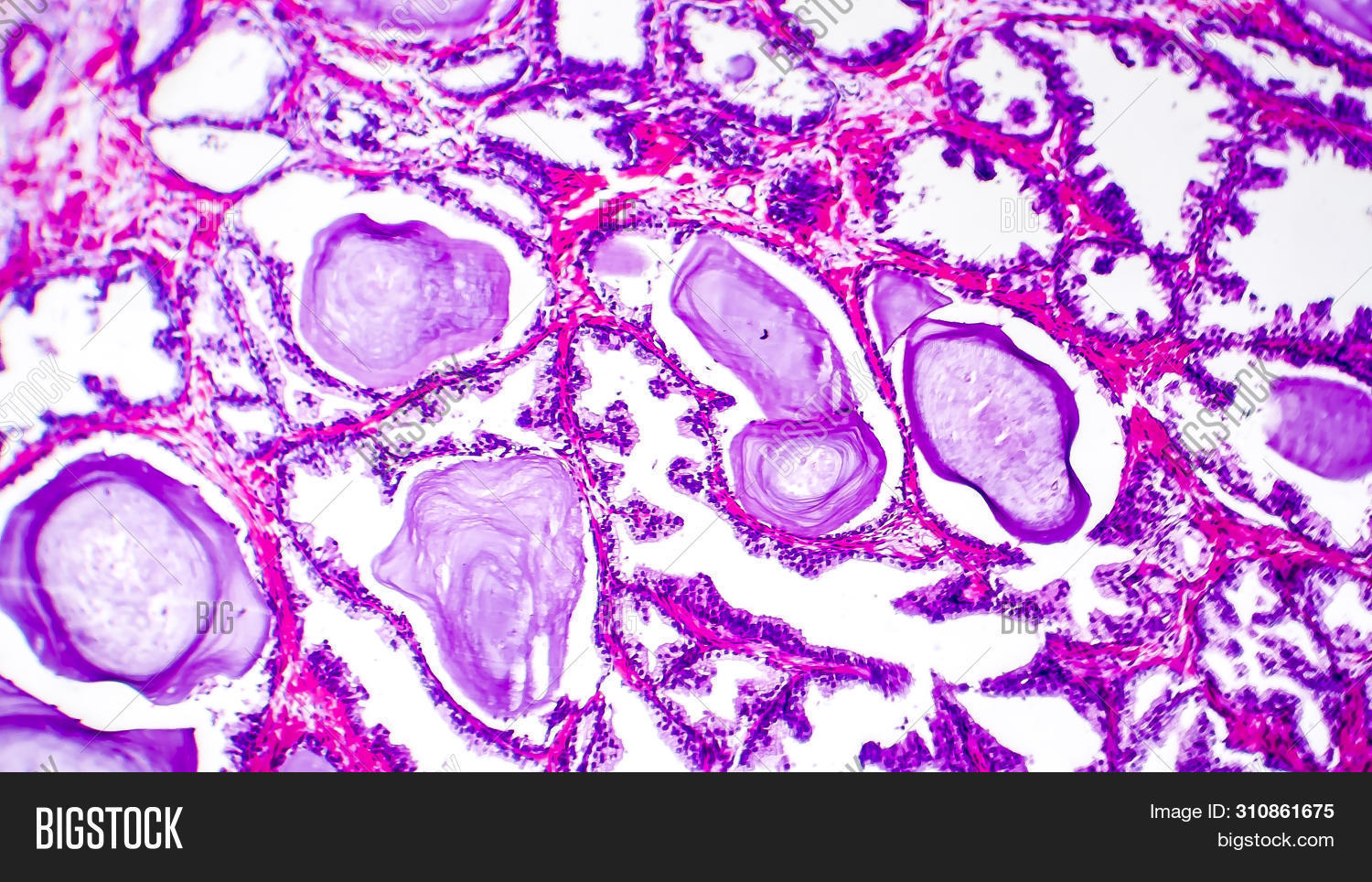 Histopathology Of Prostate Gland Hyperplasia, Light Micrograph, Photo ...