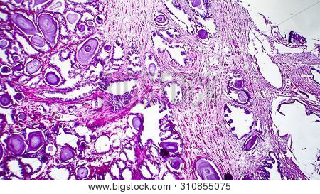 Histopathology Of Prostate Gland Hyperplasia, Light Micrograph, Photo ...