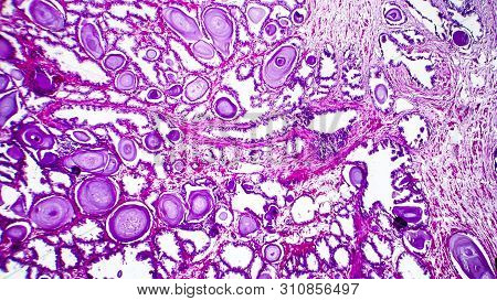 Histopathology Of Prostate Gland Hyperplasia, Light Micrograph, Photo ...