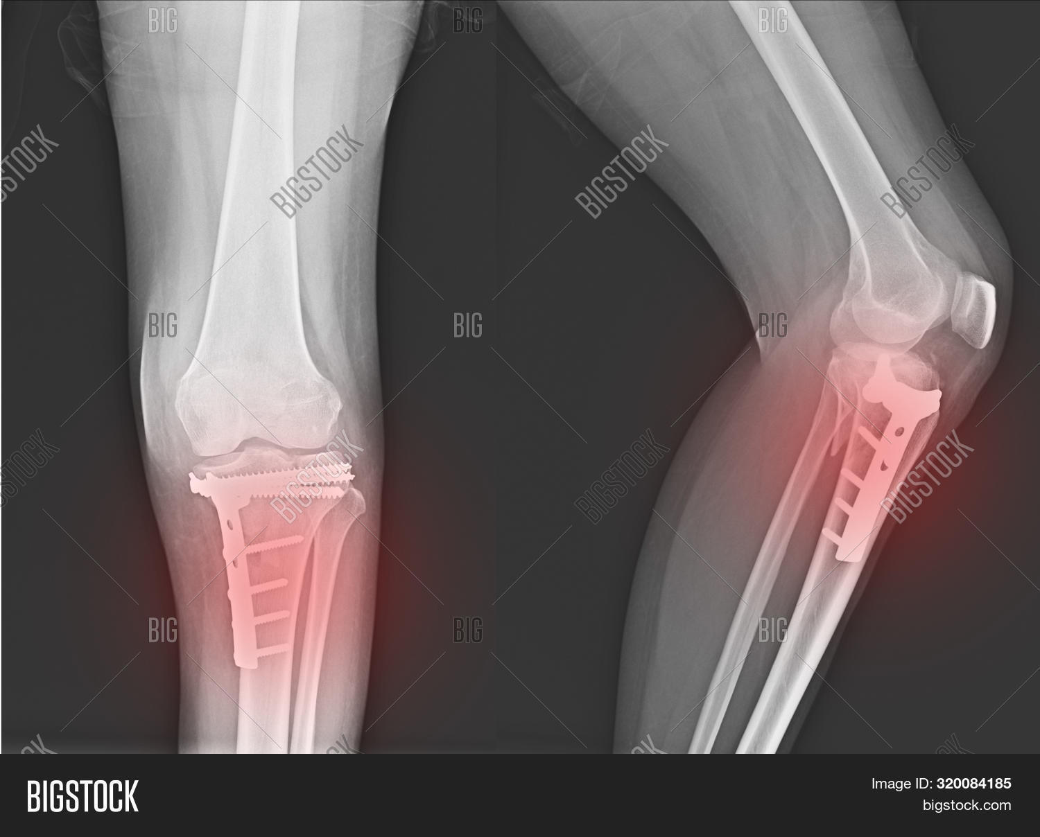 X-ray Knee Joint Fracture Proximal Tibia And Post Fix Fracture Proximal ...