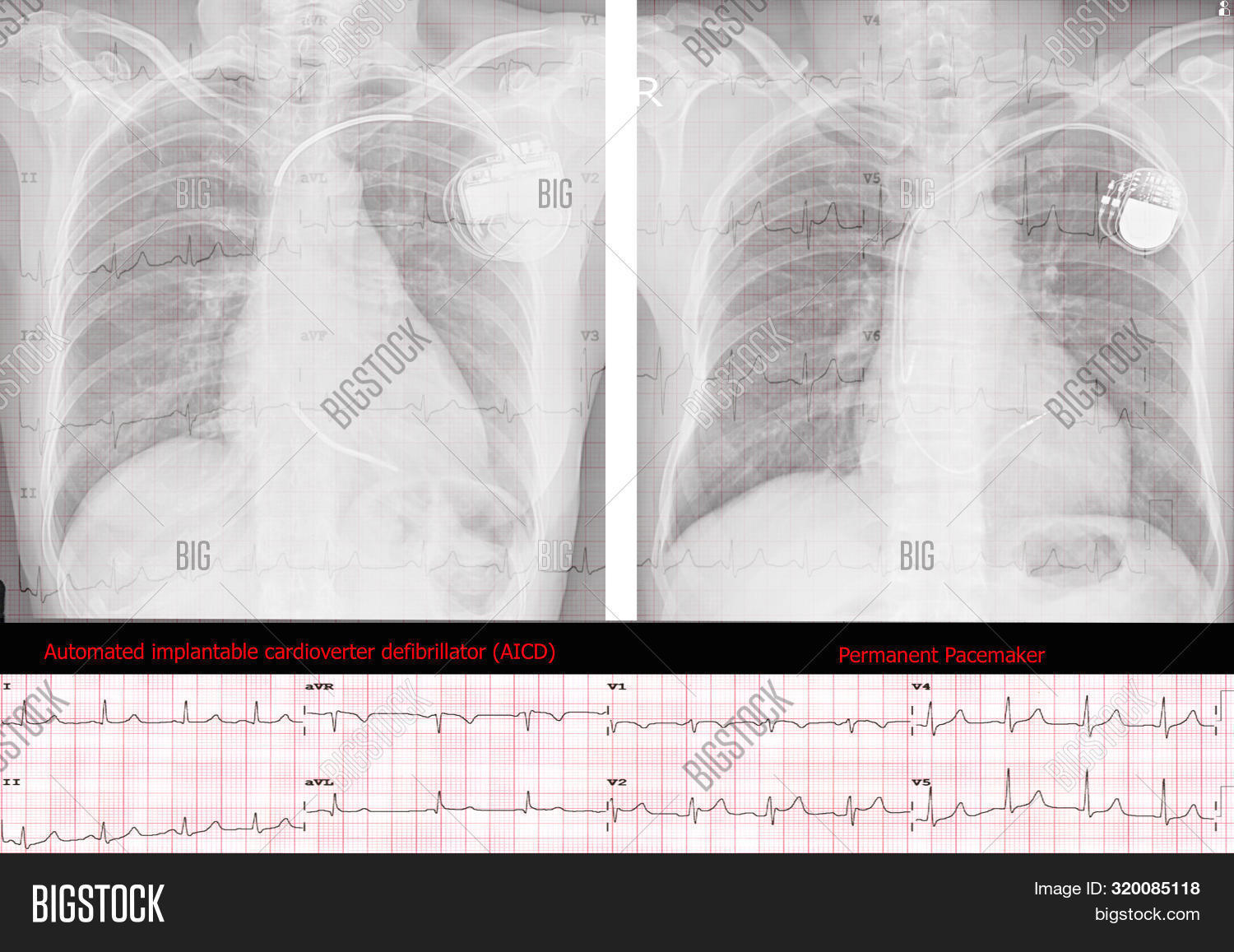 Automated Implantable Cardioverter Defibrillator (aicd) And Permanent ...