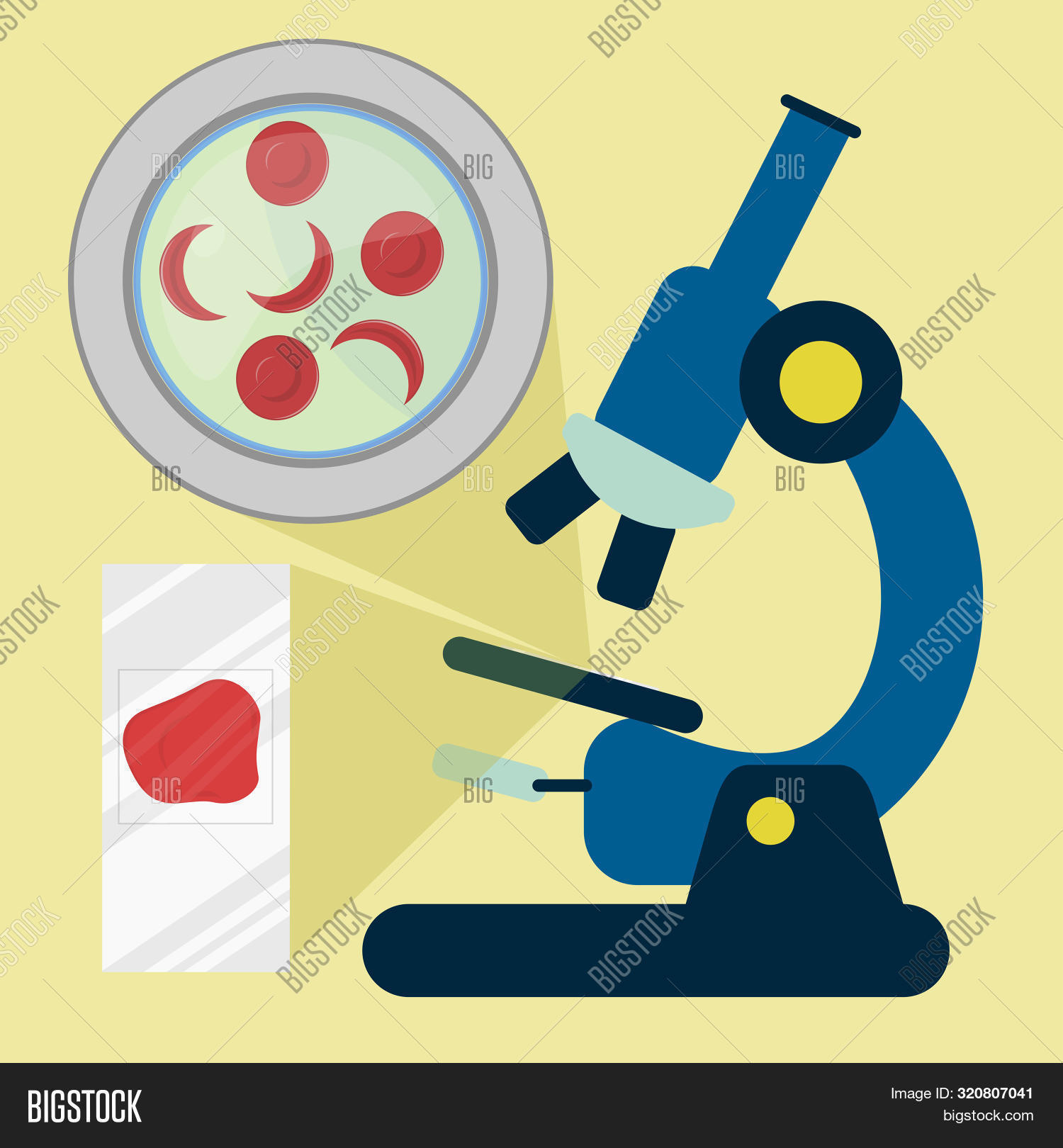 Blood Sample Under A Microscope Showing Red Blood Cells With Sickle Red ...