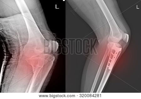 X-ray Knee Joint Fracture Proximal Tibia And Post Fix Fracture Proximal ...