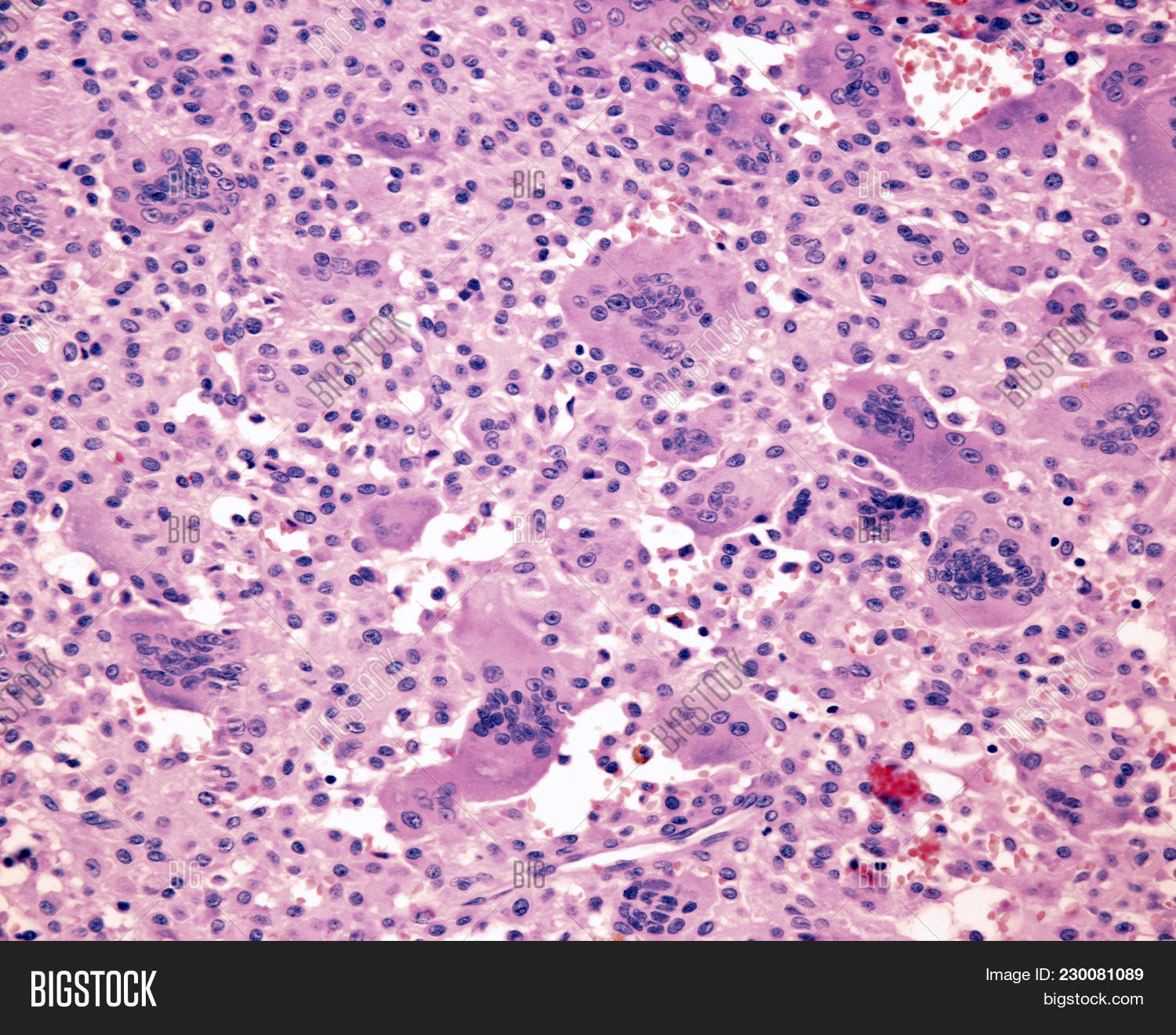 Multinucleated Giant Cells. Light Micrograph Of A Giant Cell Tumour Of ...