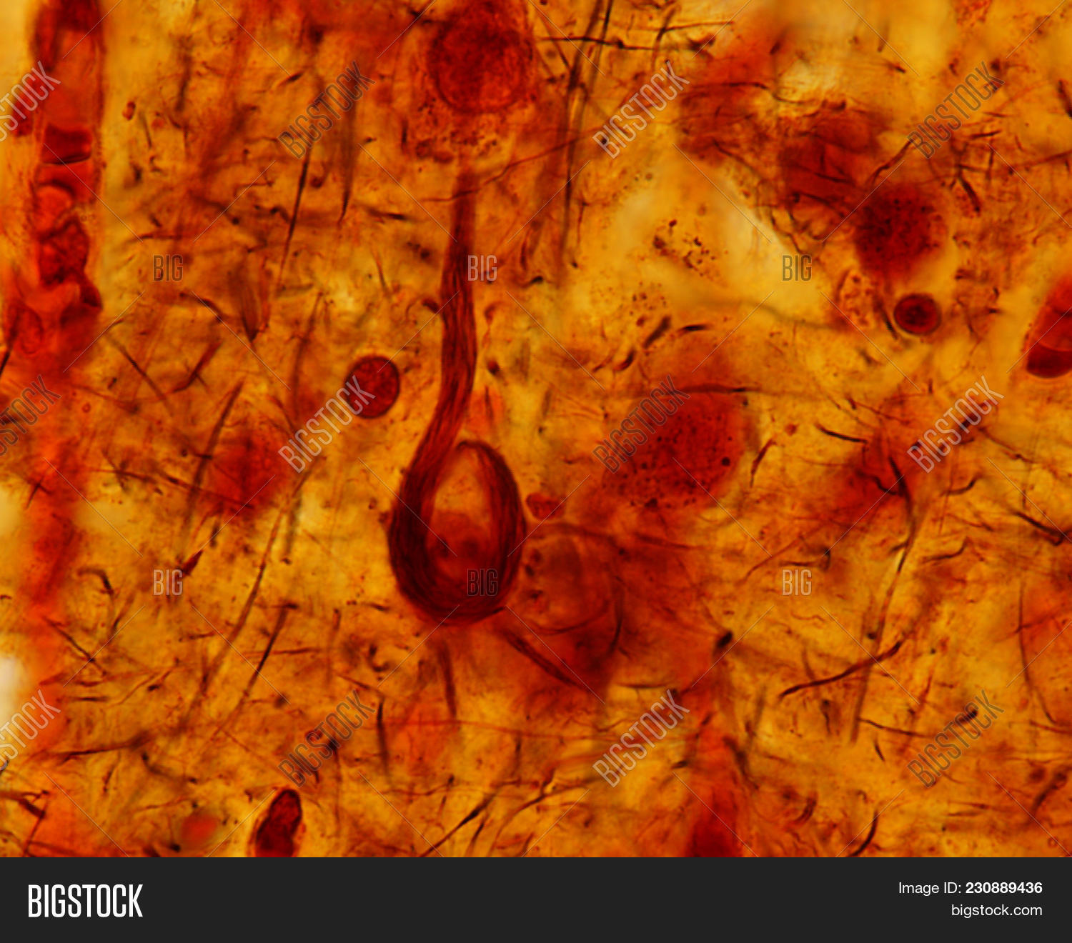 Light Microscope Micrograph Of A Senile Cerebrum, Stained With A Silver ...
