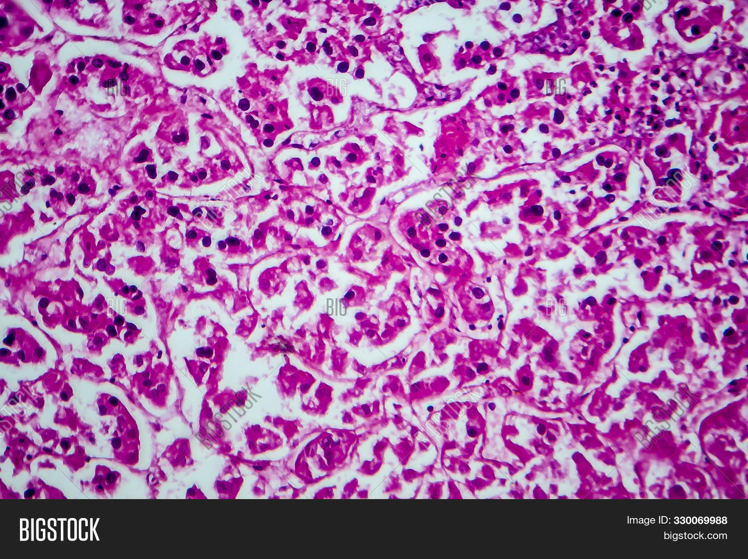 Renal Cell Carcinoma, Light Micrograph, Photo Under Microscope image ...