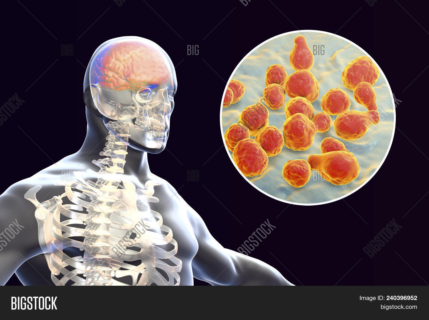 Cryptococcal Meningitis, 3d Illustration. Pathogenic Yeast Fungus ...
