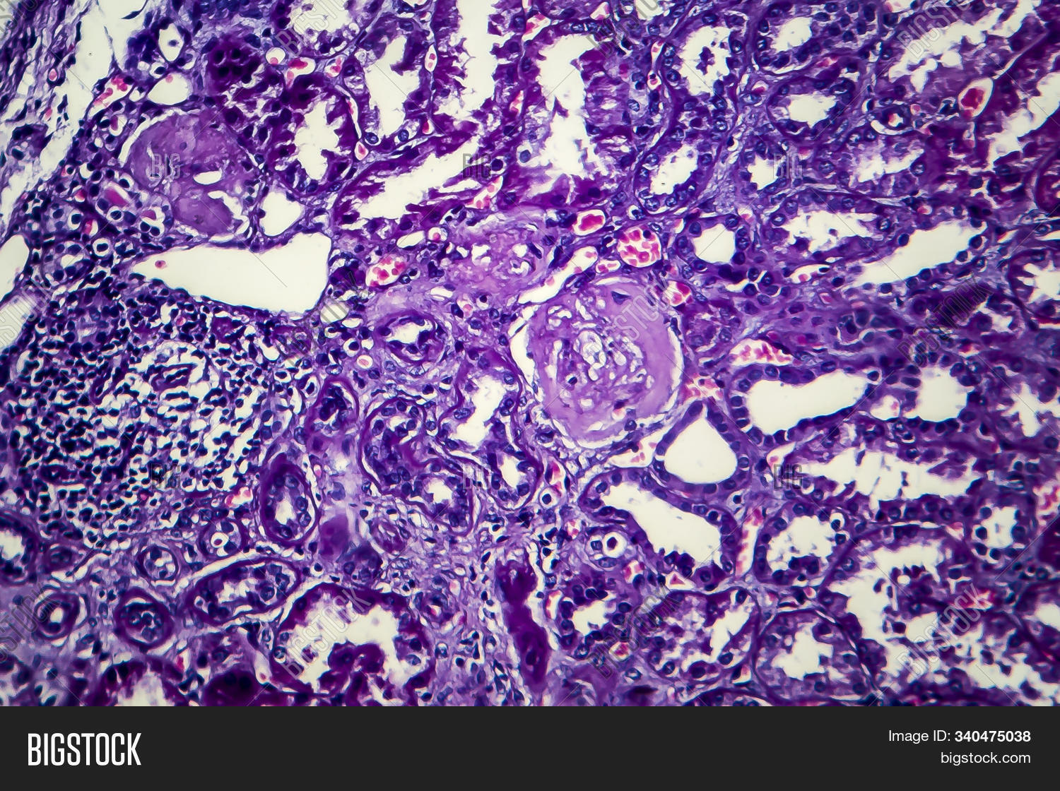 Chronic Nephritis, Light Micrograph, Photo Under Microscope image ...