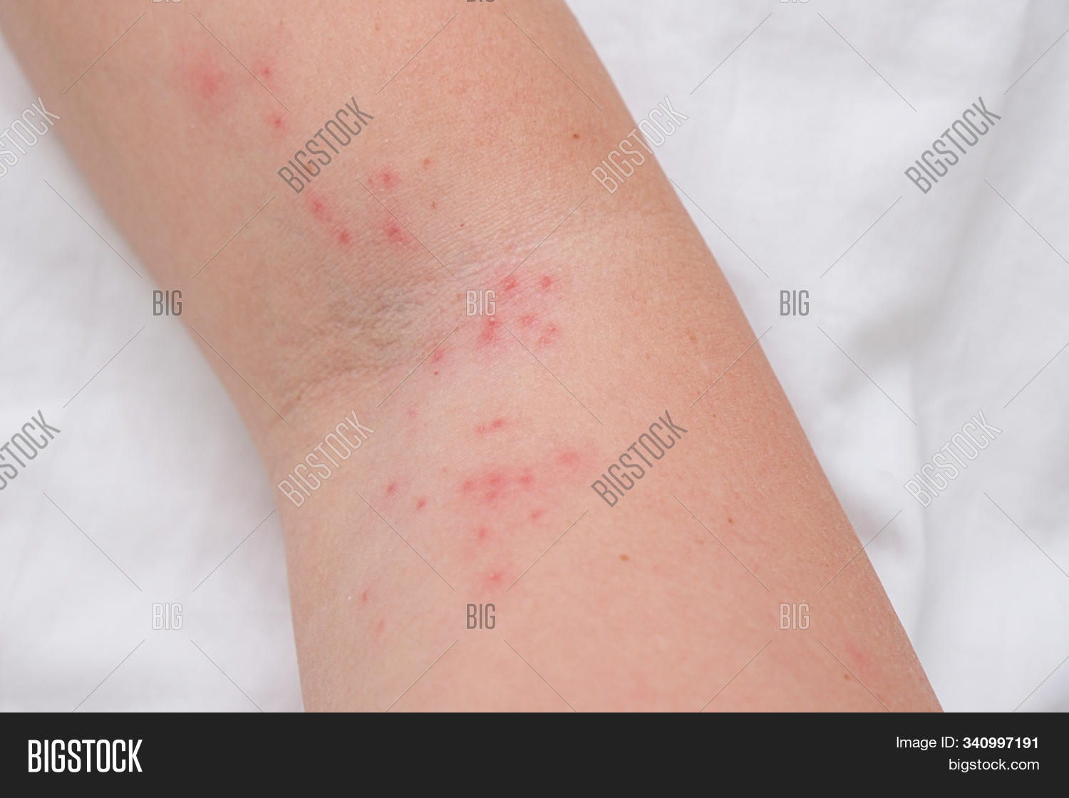 Skin Rash On Female Arm, Itchy Pimples As A Result Of An Allergic ...