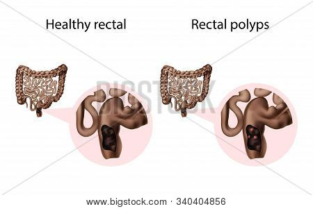 Rectal Polyps And Healthy Organ. Abnormal Growth Of Tissue. Medical ...