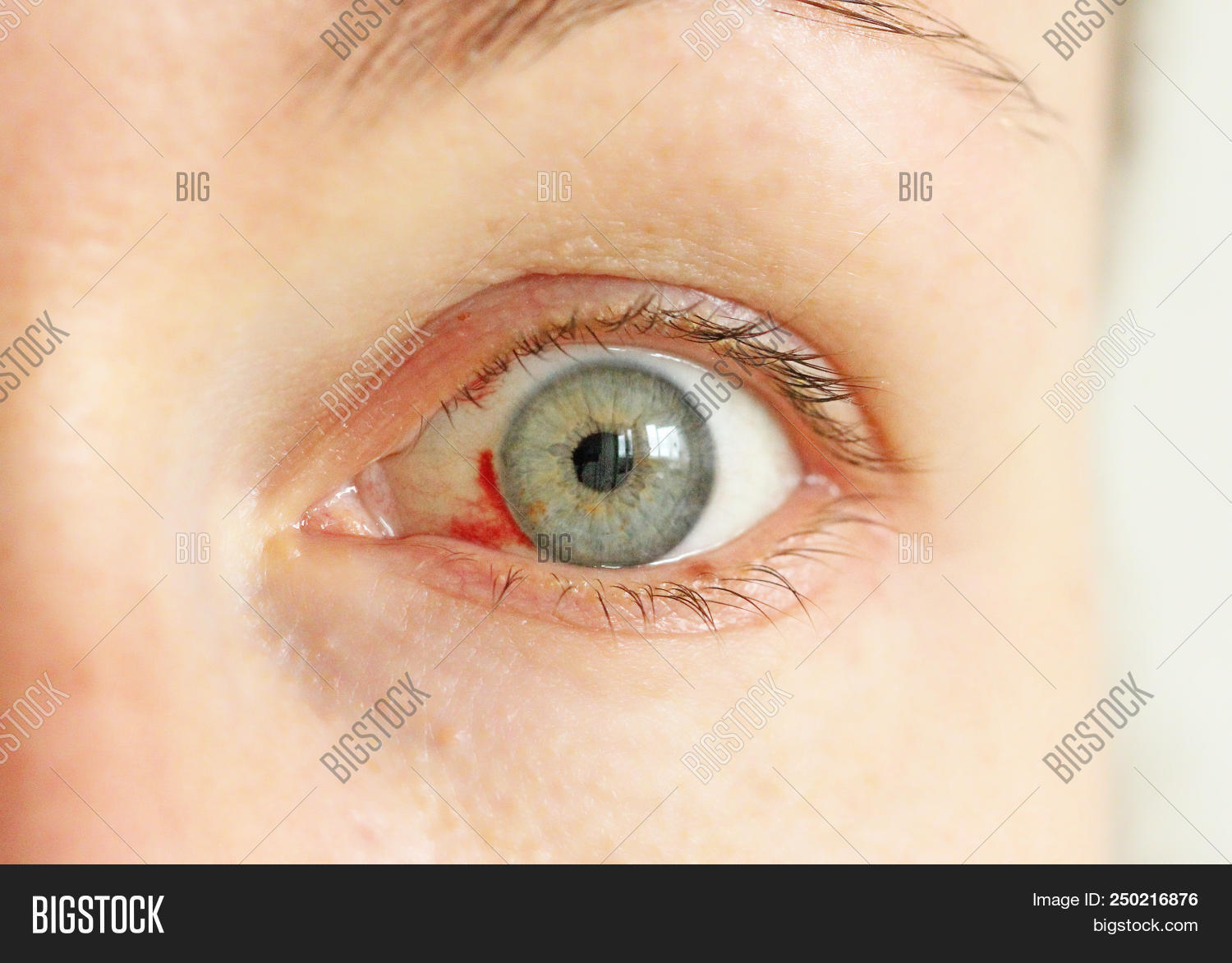 Bloodshot Eye. Woman With Burst Blood Vessel In Eye. Very Red Bloody ...