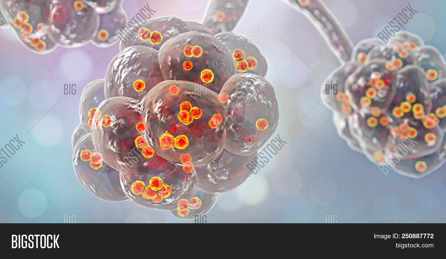 Staphylococcal Pneumonia, Medical Concept. 3d Illustration Showing ...
