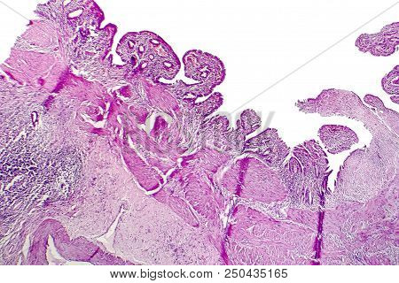 Chronic Cholecystitis, Light Micrograph, Photo Under Microscope Showing ...