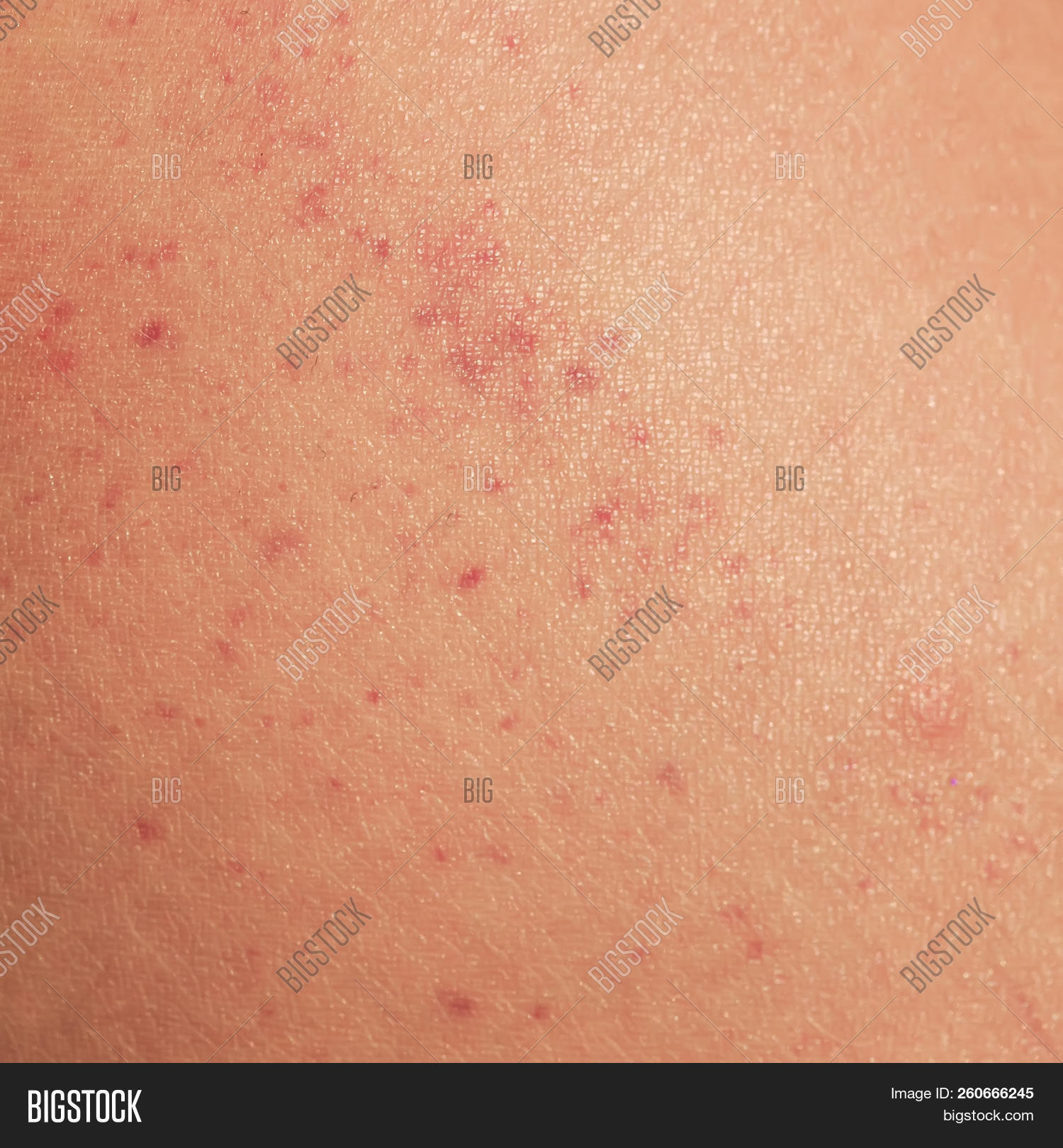 Sick Human Skin Texture Covered With Red Allergic Spots And Irritations ...