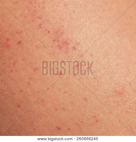 Sick Human Skin Texture Covered With Red Allergic Spots And Irritations ...