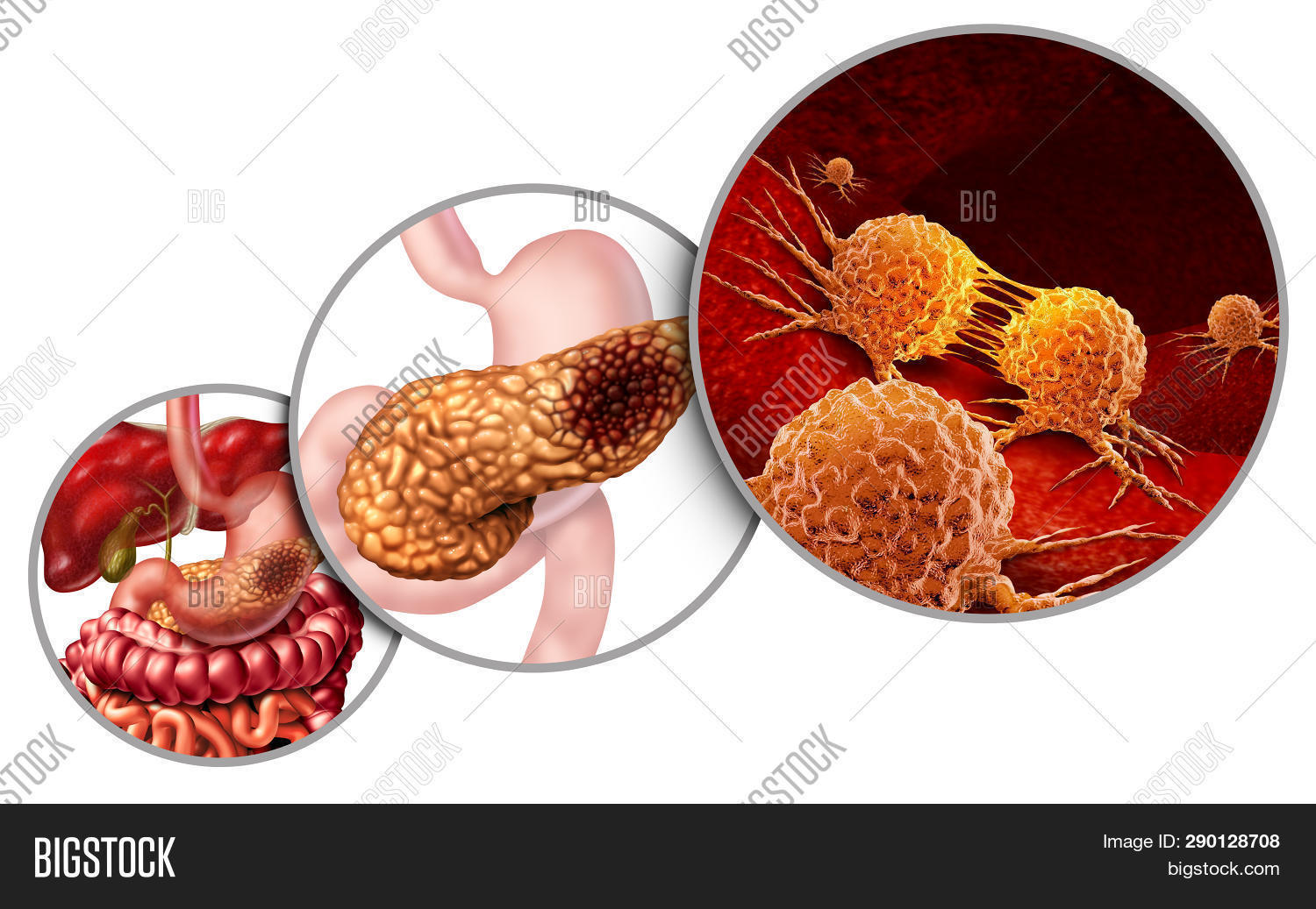 Pancreas Cancer Anatomy Diagram And Pancreatic Malignant Tumor Concept ...