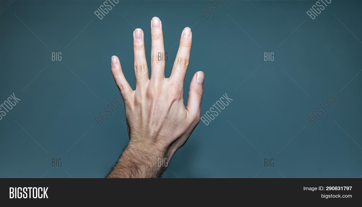 Left Hand With Broken Finger And Ganglion Cyst image & stock photo ...