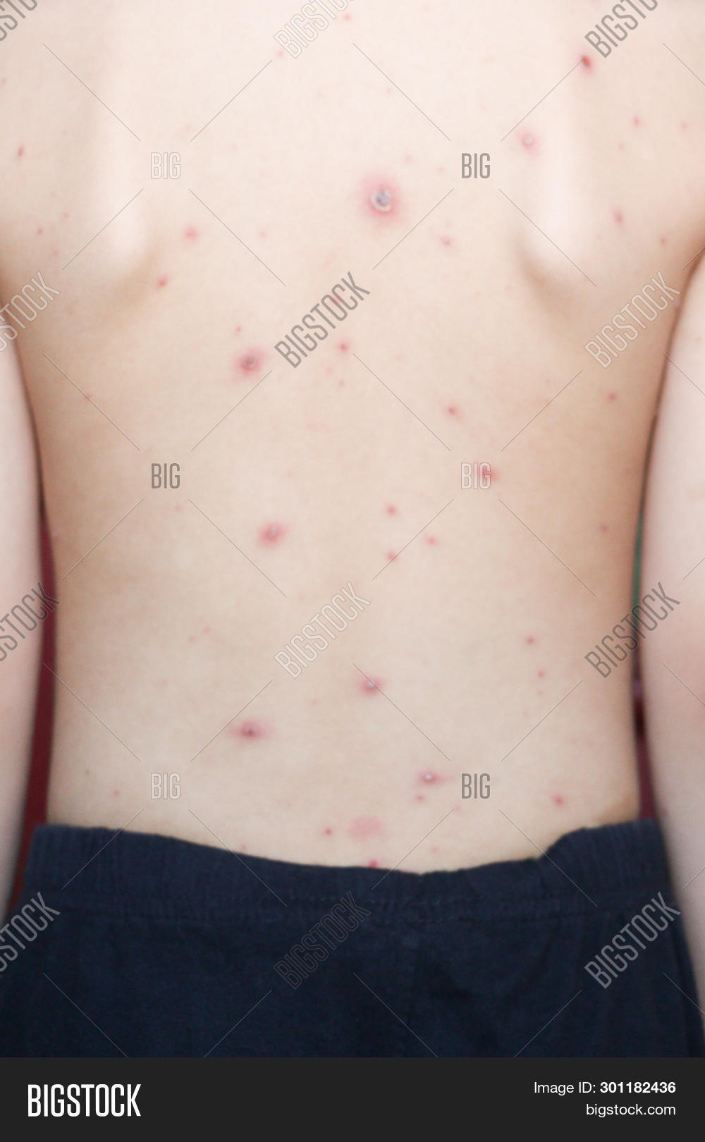 Chicken Pox Rash On Young Boy Body.chickenpox Is An Infection Caused By ...