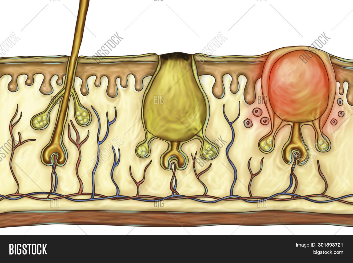 Histology Of Acne Lesions. Illustration Showing Normal Hair With ...