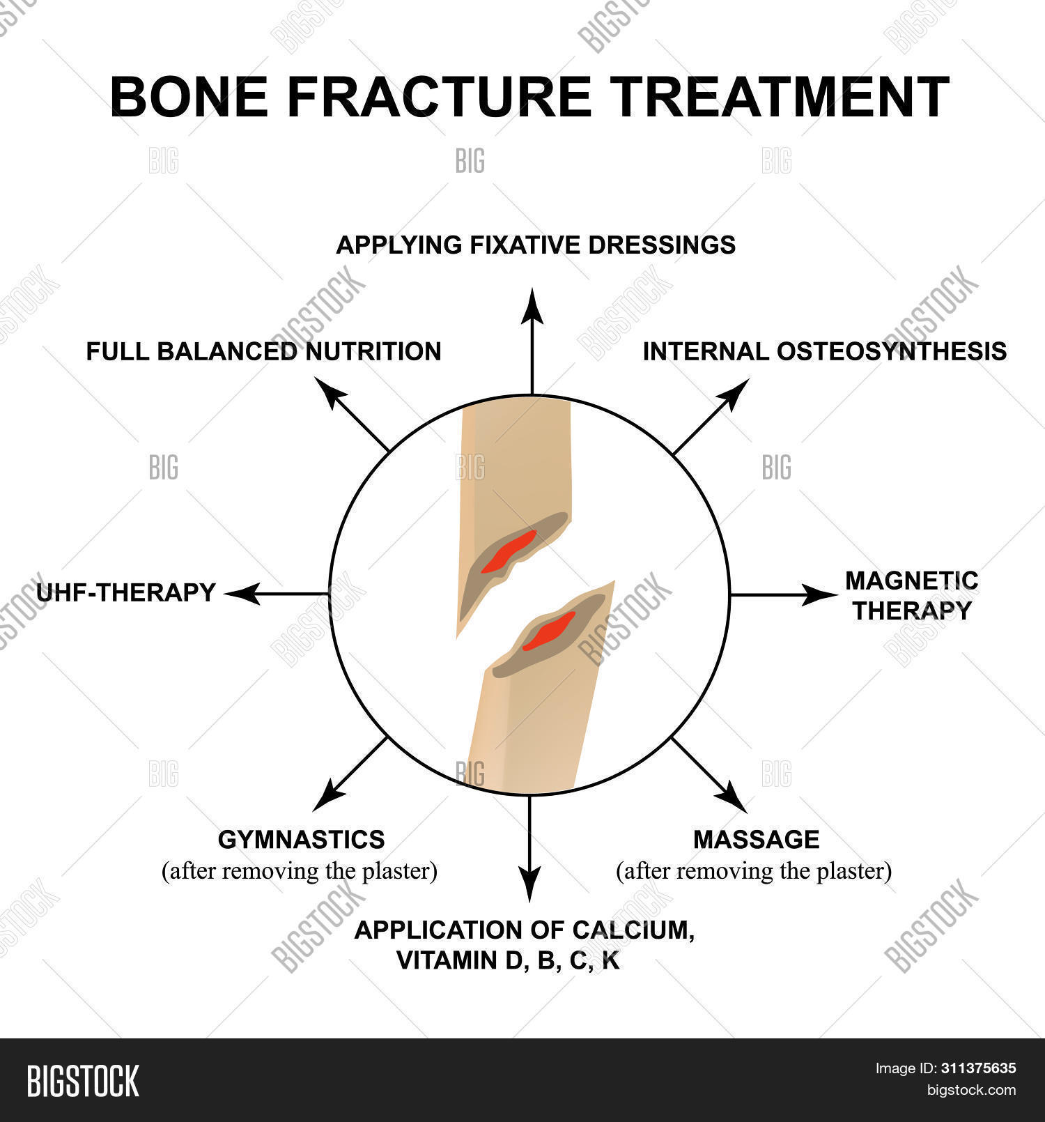Treatment Of Bone Fractures. Bone Fracture With Displacement ...