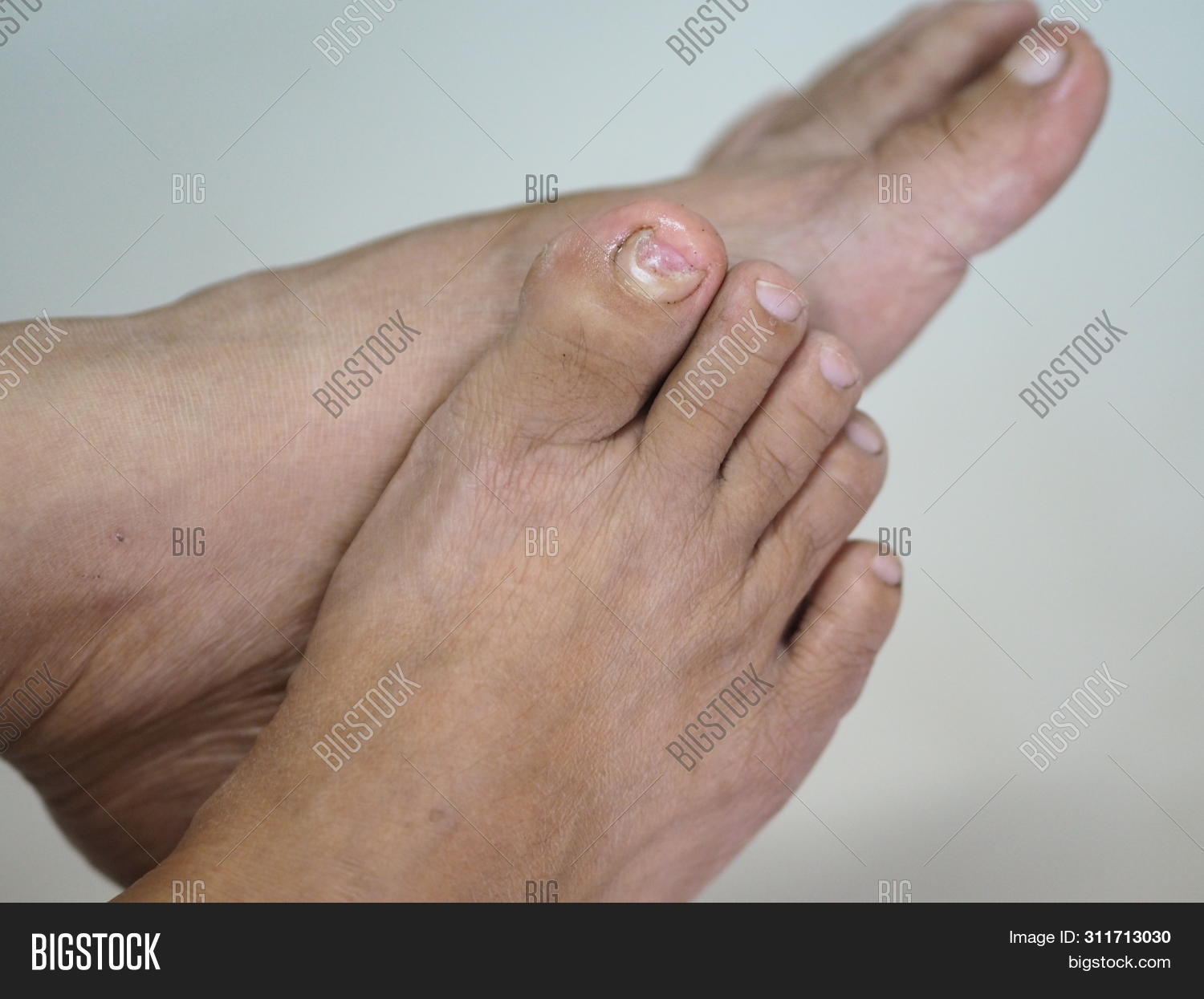 Closeup Fungal Nail Infection Onychomycosis Tinea Unguium image & stock ...