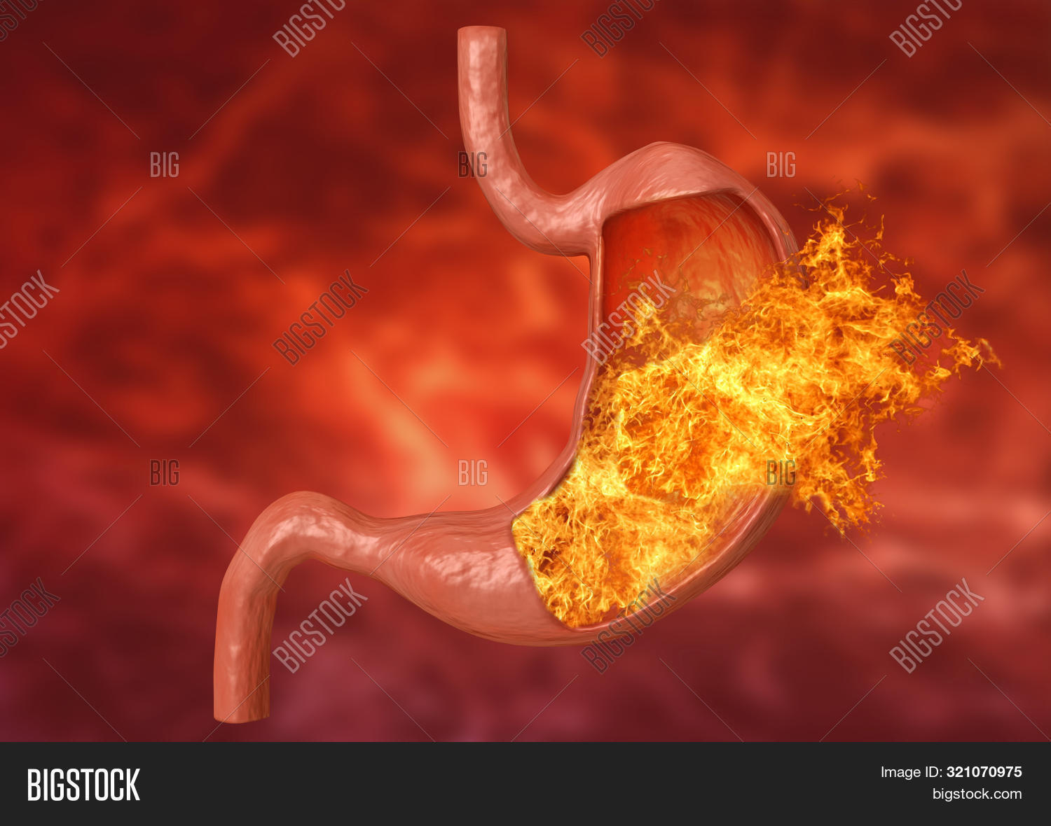 Stomach Fire. Excessive Acidity, Indigestion, Stomach Disease, Gastric ...