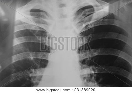 X-ray Of A Human Chest Or Lungs Radiography Shot. Medical Technology ...