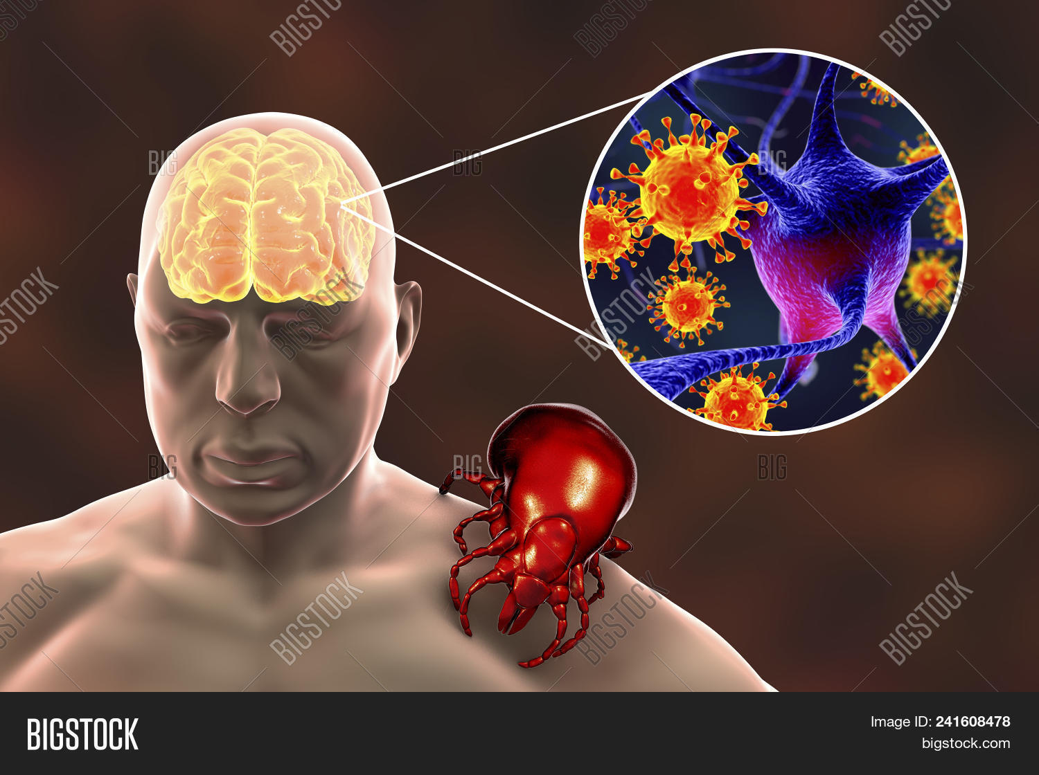 Tick-borne Encephalitis Concept, 3d Illustration Showing Brain ...