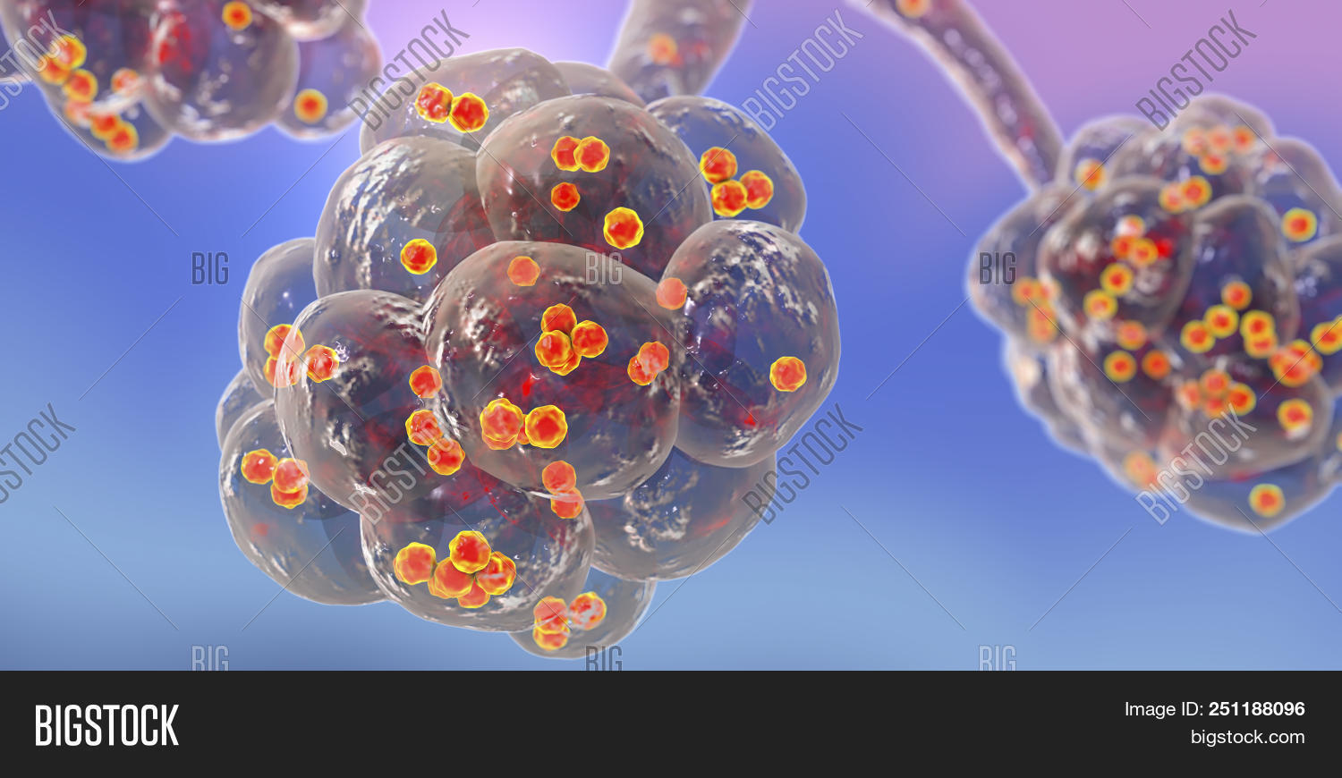Staphylococcal Pneumonia, Medical Concept. 3d Illustration Showing ...