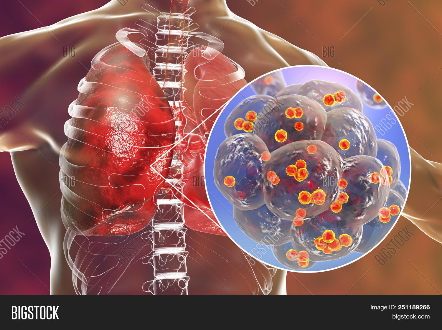 Staphylococcal Pneumonia, Medical Concept. 3d Illustration Showing ...