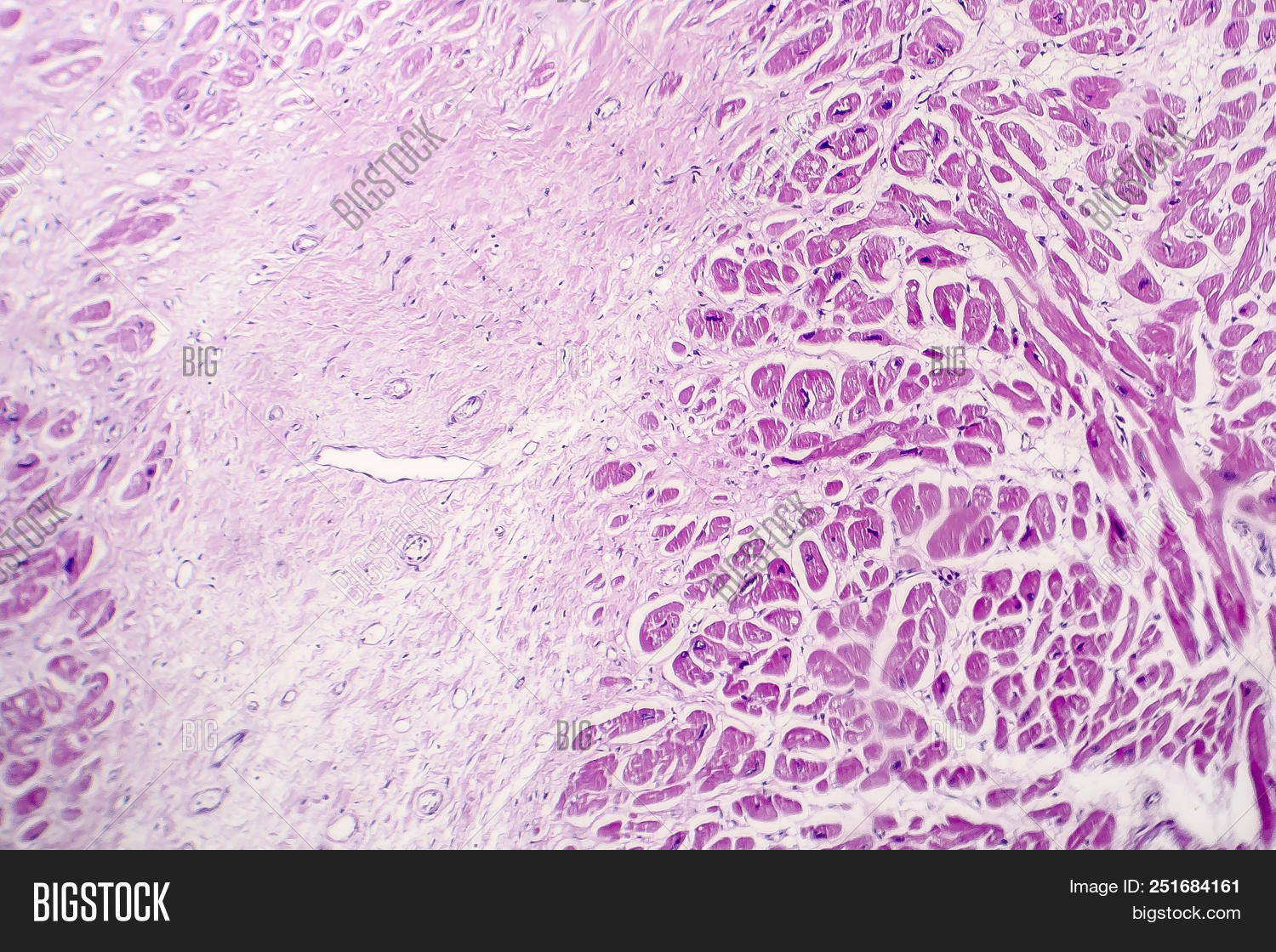 Acute Myocardial Infarction, Histology Of Heart Tissue, Light ...