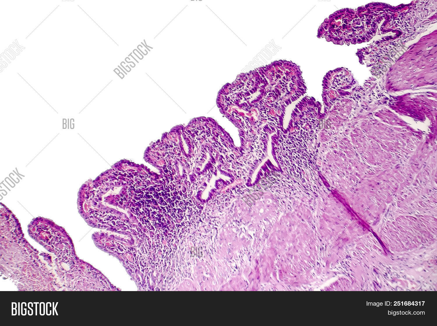 Chronic Cholecystitis, Light Micrograph, Photo Under Microscope Showing ...
