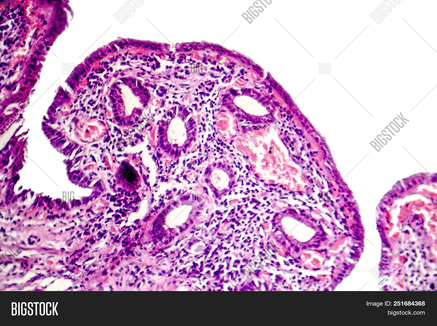 Chronic Cholecystitis, Light Micrograph, Photo Under Microscope Showing ...