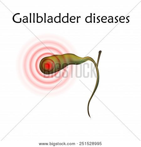 Gallbladder Diseases, Inflammation. Gallstones. Cholecystitis. Anatomy ...