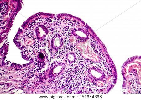 Chronic Cholecystitis, Light Micrograph, Photo Under Microscope Showing ...