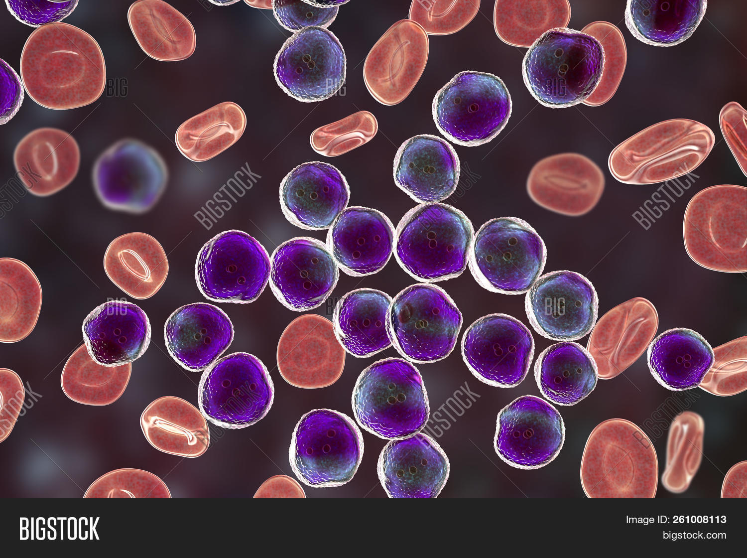 Acute Lymphoblastic Leukemia, Bone Marrow Smear, 3d Illustration image ...