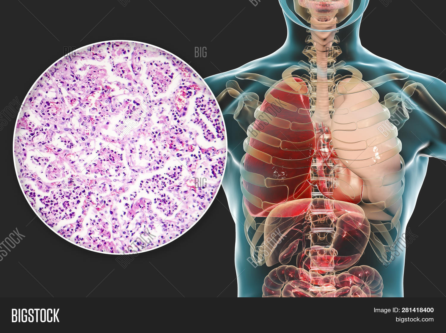 Lobar Pneumonia, Red Hepatic Phase, 3d Illustration And Light ...