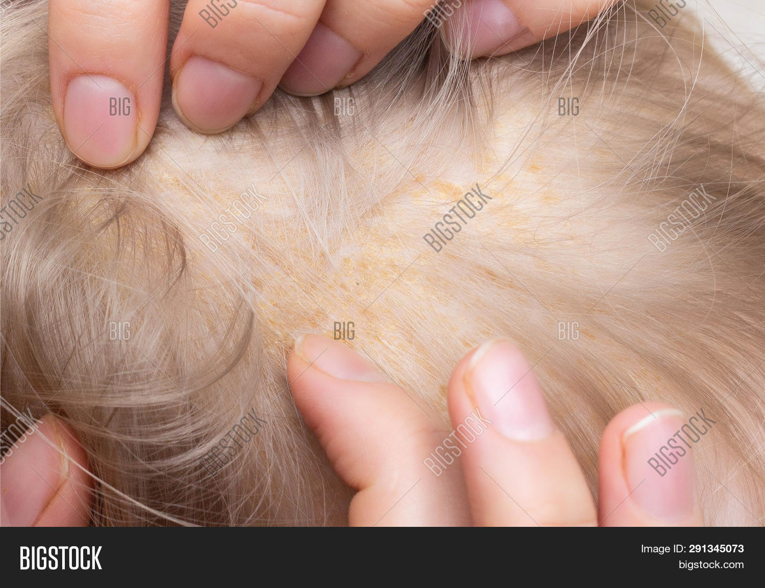 Seborrheic Skin Rash On The Child S Head, Seborrheic Dermatitis, Close ...