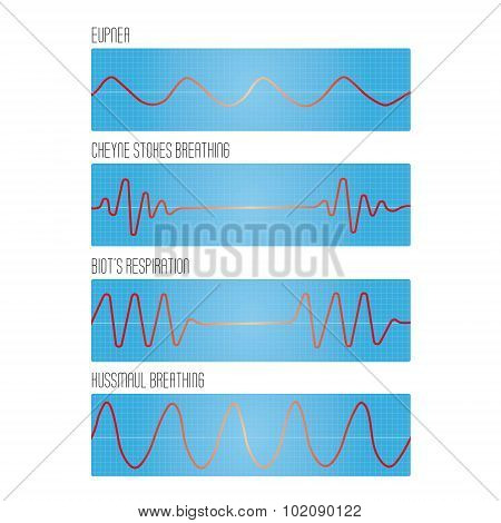 Graph of breathing, the pathological types of breathing: normal breathing, Cheyne-Stokes ...