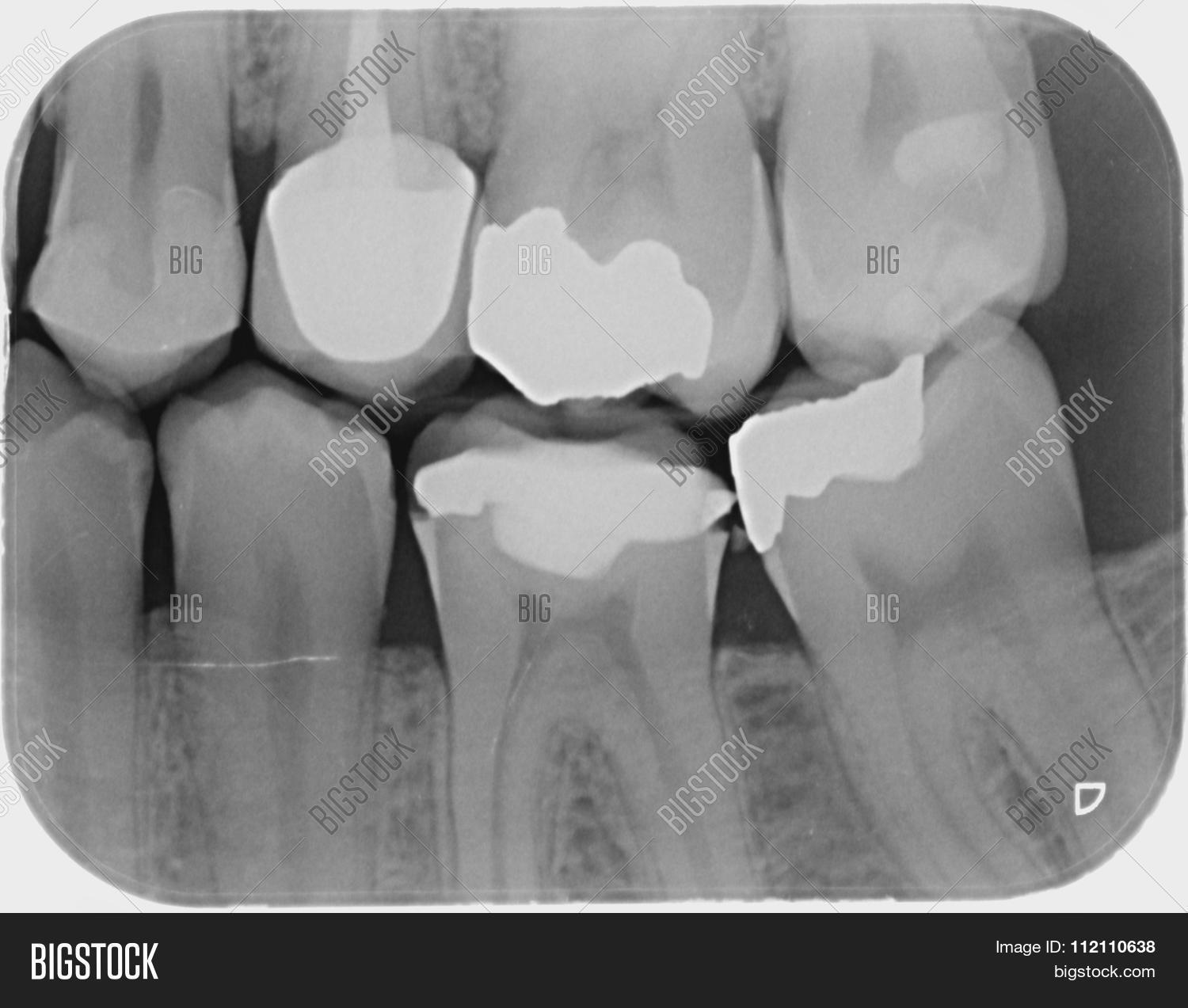 Dental x-ray for check dental caries teeth bad condition image & stock ...