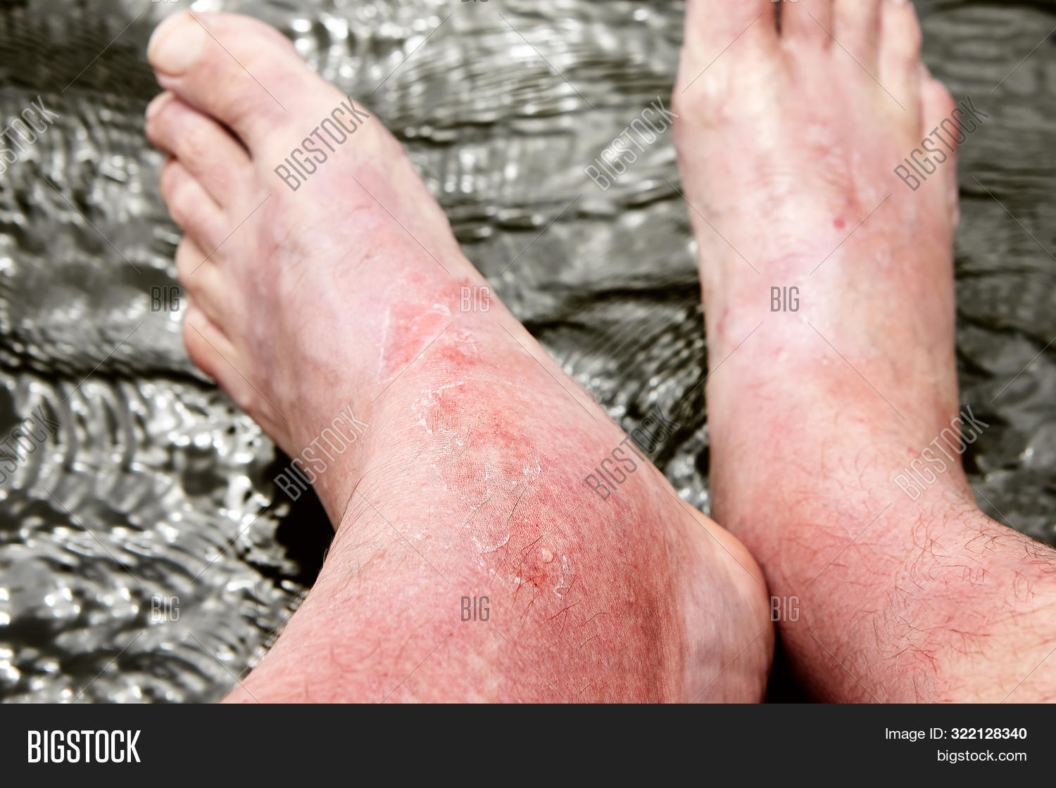 Severe Burn Of The Skin With Redness And Dermatitis, The Mans Leg Was ...