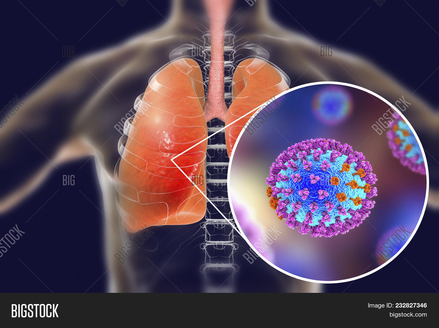 Flu Viruses In Human Lungs, 3d Illustration Showing Anatomy Of Human ...