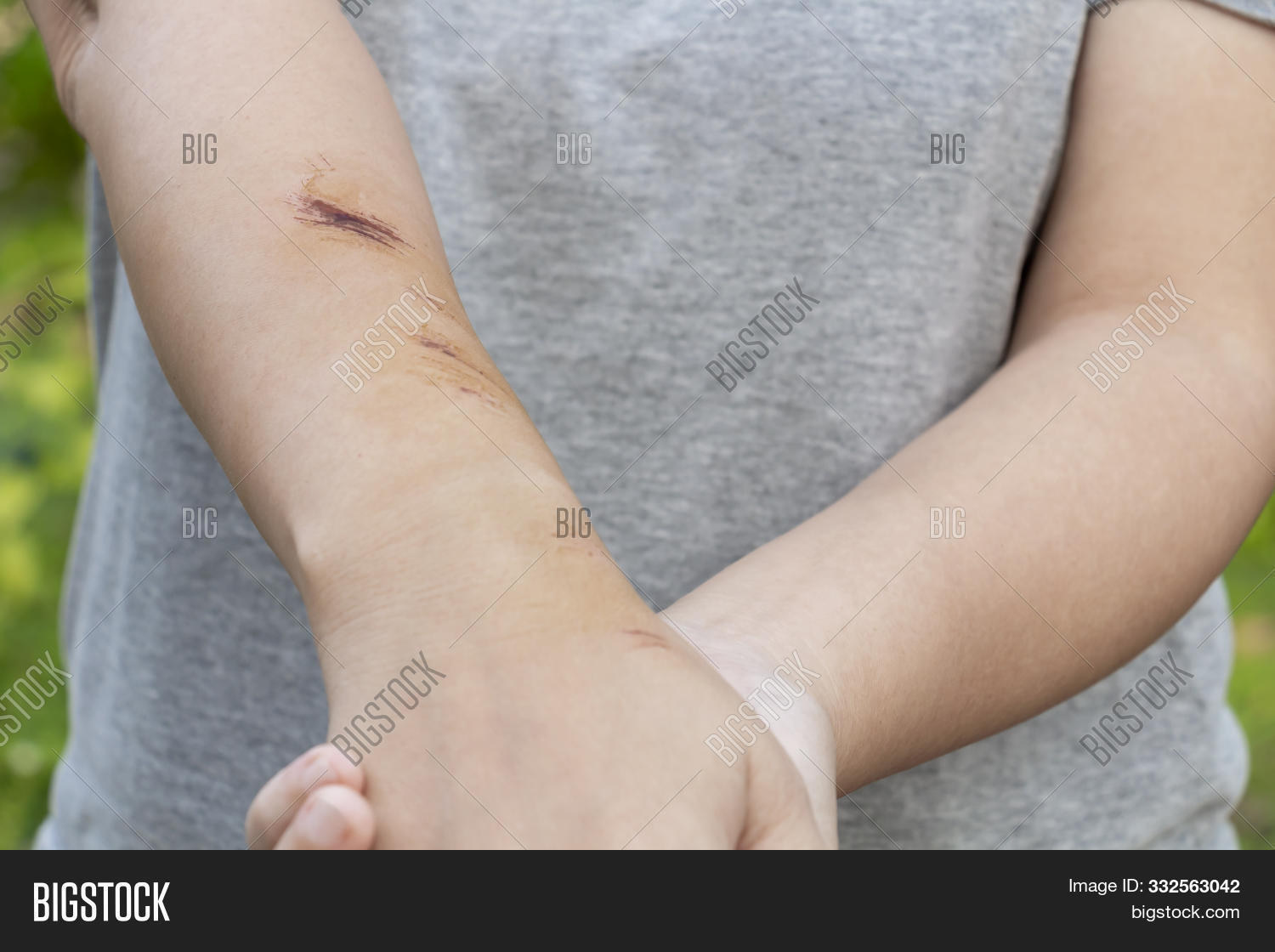 The Wound Form Scabs On Hand And Arm. The Wound Happen During Woman ...