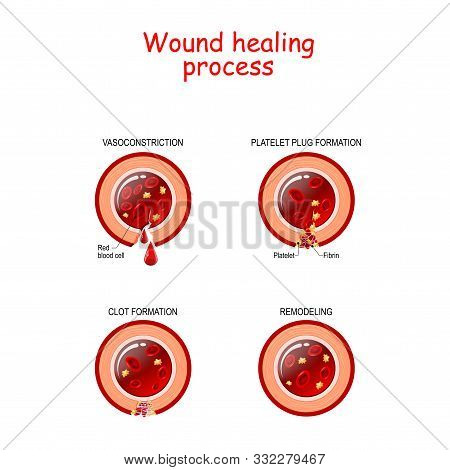 Phases Of The Wound Healing Process. Hemostasis, Inflammatory ...