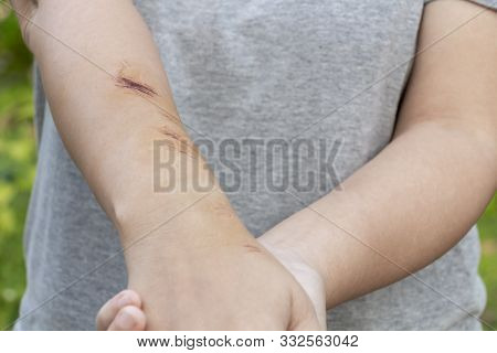 The Wound Form Scabs On Hand And Arm. The Wound Happen During Woman ...