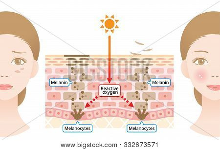 Mechanism Of Skin Cell Turnover Illustration. Melanin And Melanocytes ...
